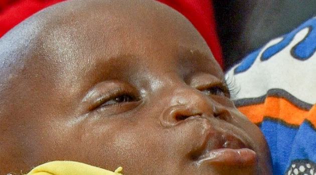 Nairobi Hospital inspires hope for cleft lip and palate cases » Capital ...
